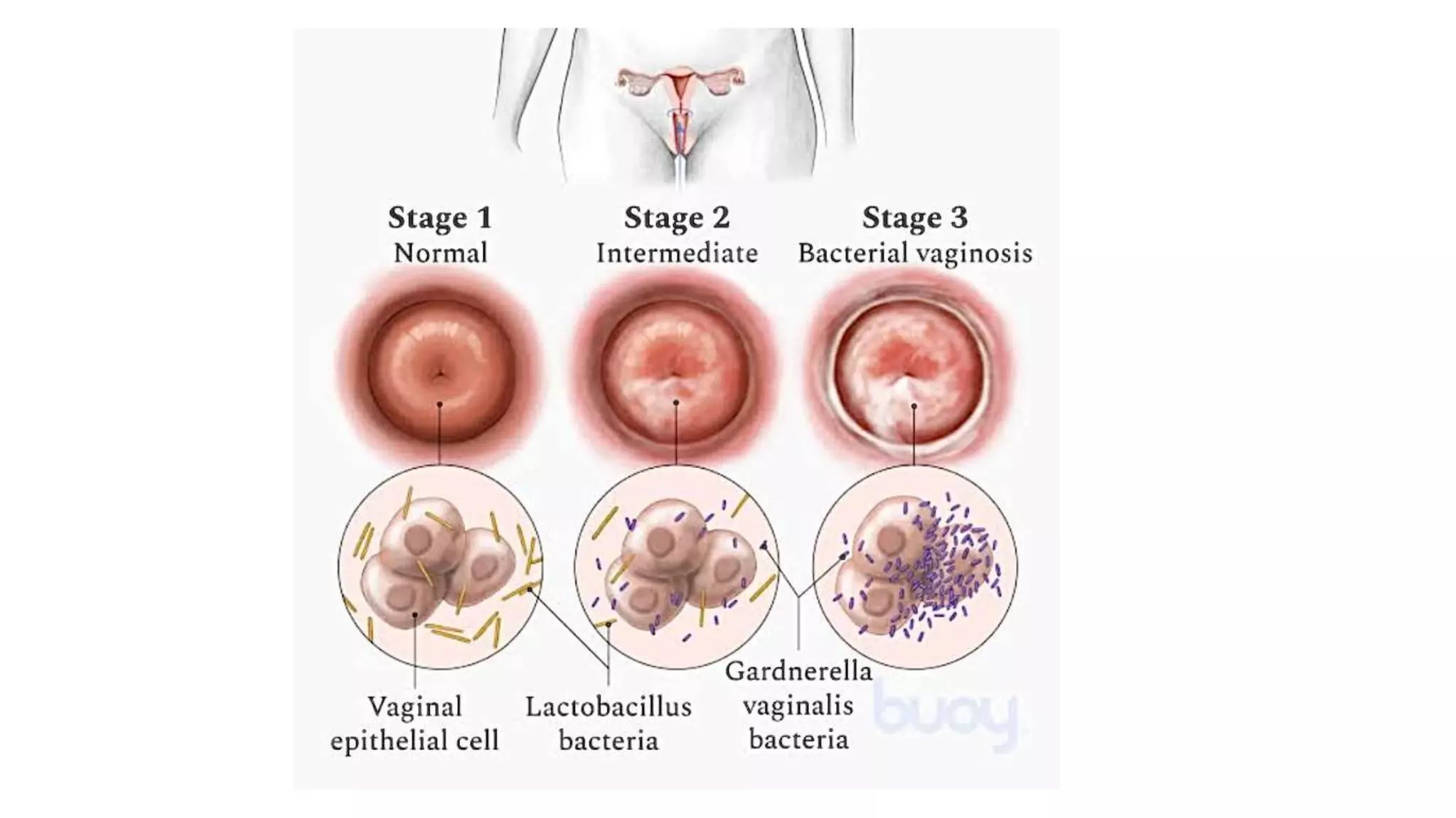 BACTERIAL VAGINOSIS final.pptx