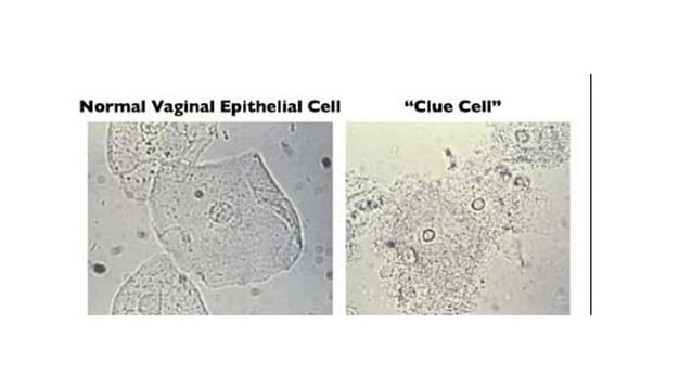 BACTERIAL VAGINOSIS final.pptx | Sexual Conditions | Sexual Health