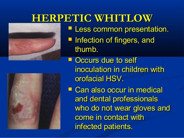 Bacterialviralmycoticinfections 100101095926-phpapp01