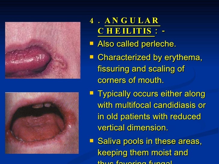 Bacterial, Viral & Mycotic Infections