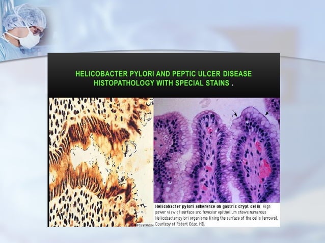 Bacterium helicobacter pylori | PPT