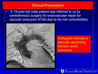 TEVAR for ATAA with Minimalist Approach | PPT