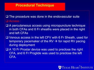 TEVAR for ATAA with Minimalist Approach | PPT