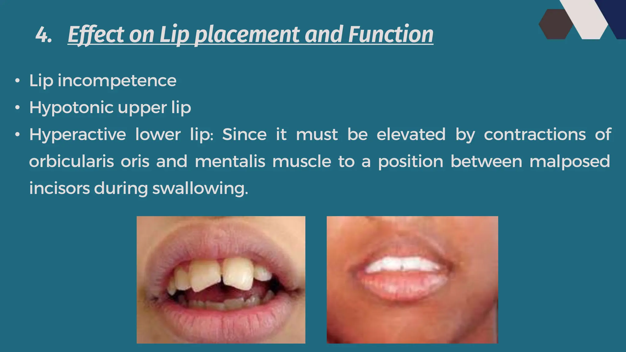 Bad oral habits in orthodontic..... pptx | PPTX