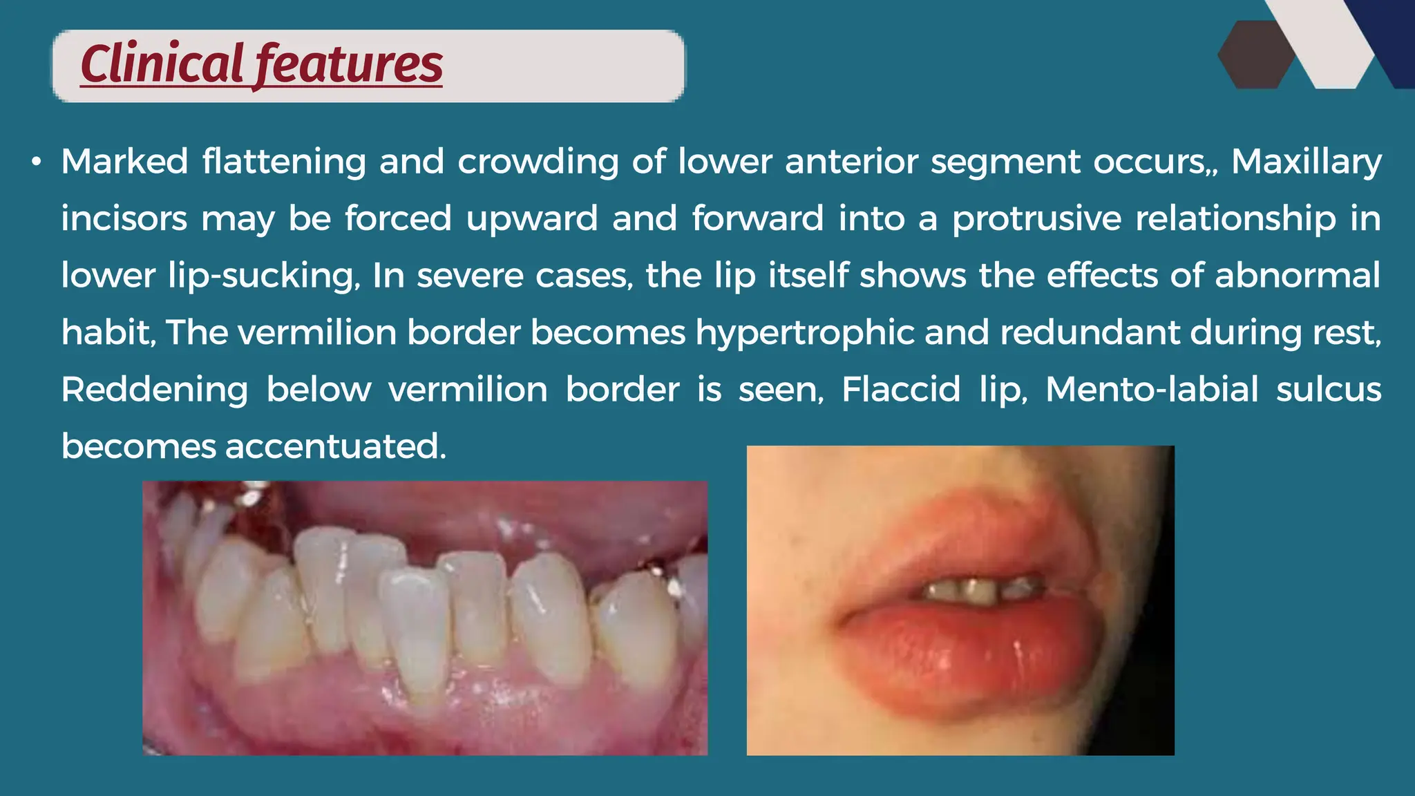Bad oral habits in orthodontic..... pptx | PPTX