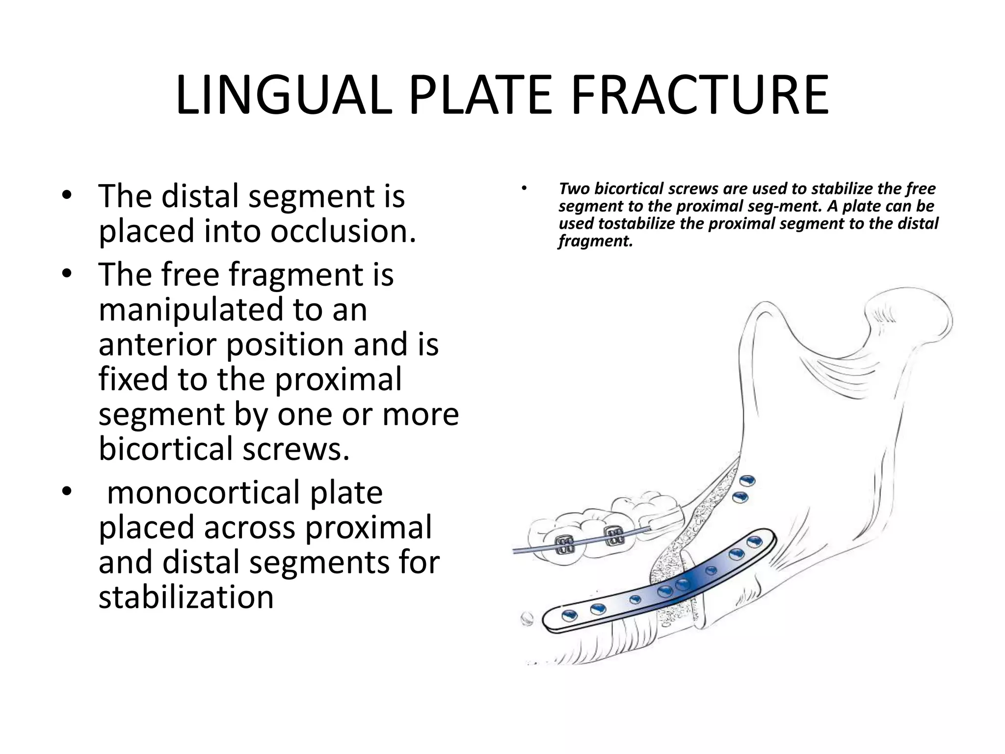 Bad splits in bsso | PPTX