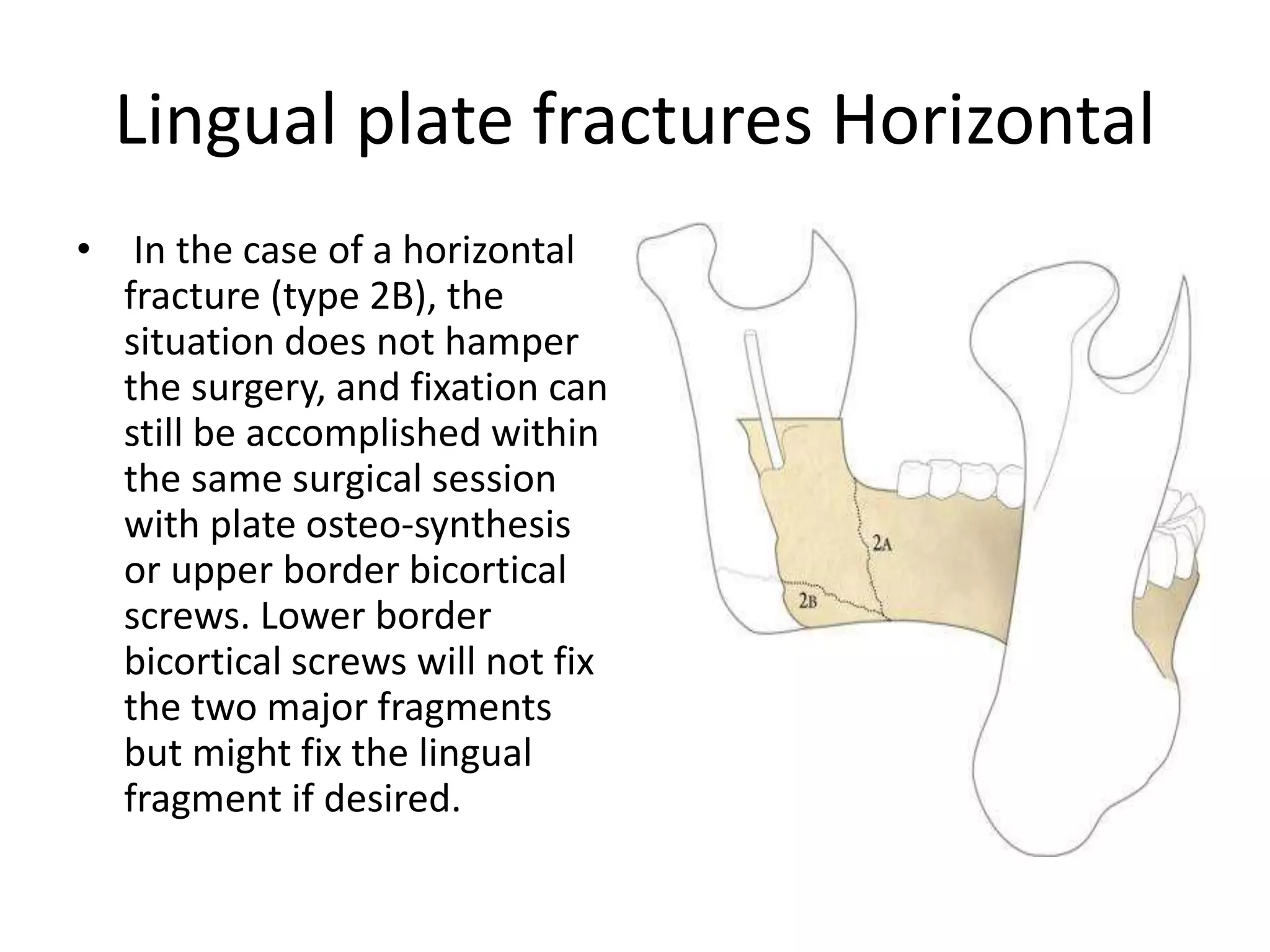 Bad splits in bsso | PPTX
