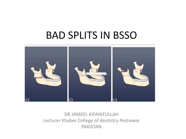 Bad splits in bsso | PPTX | Bone and Joint Conditions | Diseases and ...