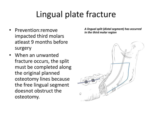 Bad splits in bsso | PPTX | Bone and Joint Conditions | Diseases and ...