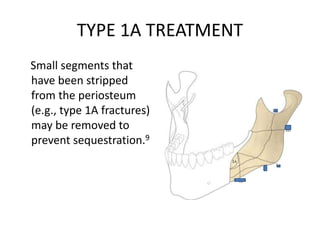Bad splits in bsso | PPTX