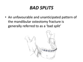 Bad splits in bsso | PPTX