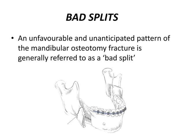Bad splits in bsso | PPTX | Bone and Joint Conditions | Diseases and ...