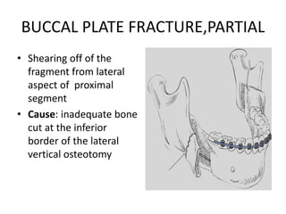 Bad splits in bsso | PPTX