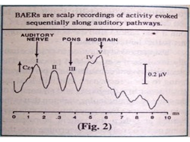 BAEP, BERA, BEP, Brainstem auditory evoked potential By Murtaza Syed