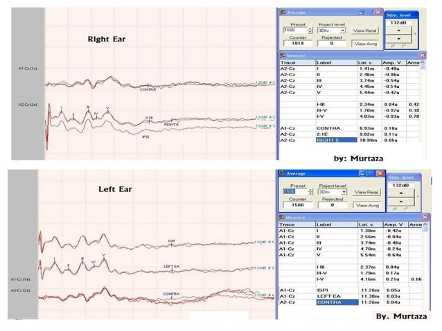 Anatomy of Ear and BERA with its technical aspects. by Murtaza. March ...