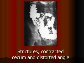 Ba follow through study for ileocecal region | PPT