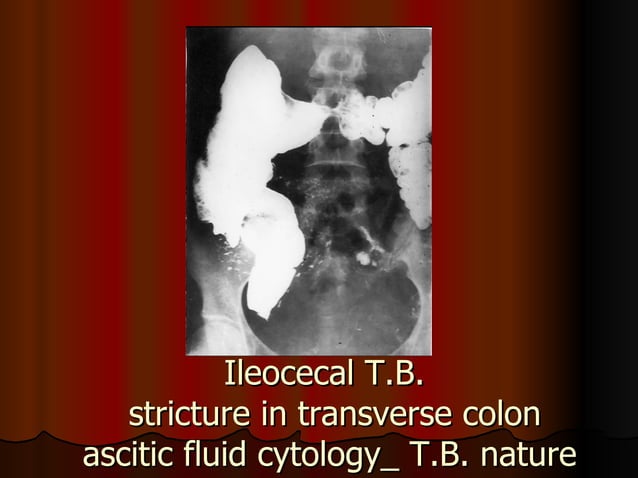 Ba follow through study for ileocecal region | PPT | Digestive ...