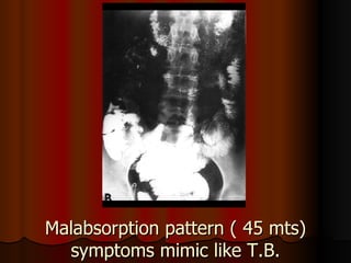 Ba follow through study for ileocecal region | PPT