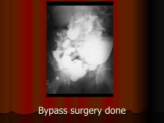 Ba follow through study for ileocecal region | PPT