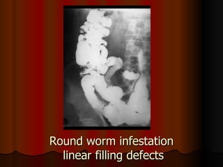 Ba follow through study for ileocecal region | PPT