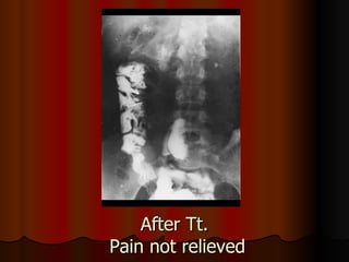 Ba follow through study for ileocecal region | PPT