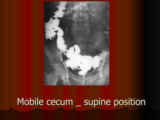 Ba follow through study for ileocecal region | PPT