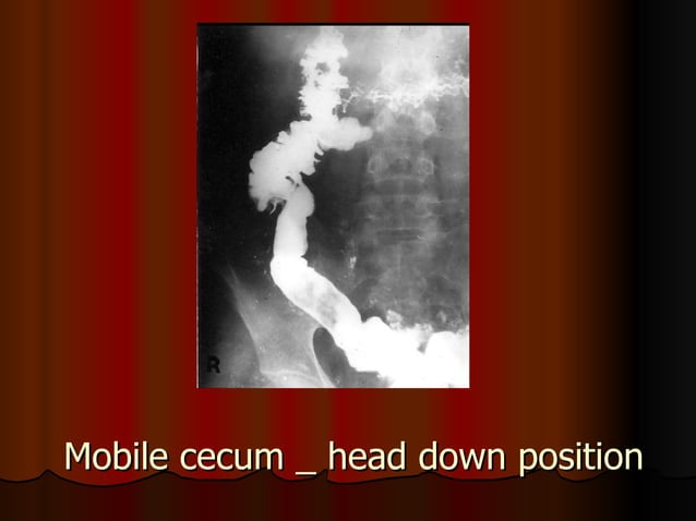 Ba follow through study for ileocecal region | PPT | Digestive ...