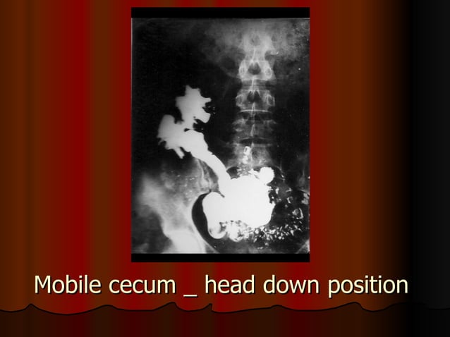 Ba follow through study for ileocecal region | PPT | Digestive ...