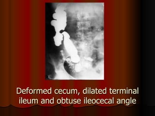 Ba follow through study for ileocecal region | PPT