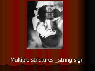 Ba follow through study for ileocecal region | PPT