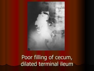 Ba follow through study for ileocecal region | PPT