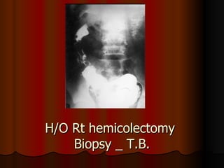 Ba follow through study for ileocecal region | PPT