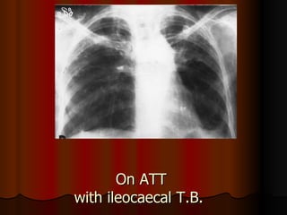 Ba follow through study for ileocecal region | PPT