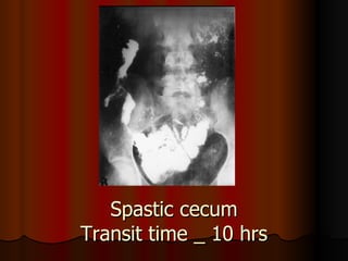 Ba follow through study for ileocecal region | PPT