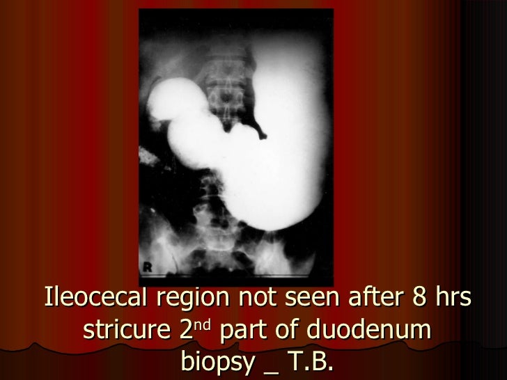 Ba follow through study for ileocecal region