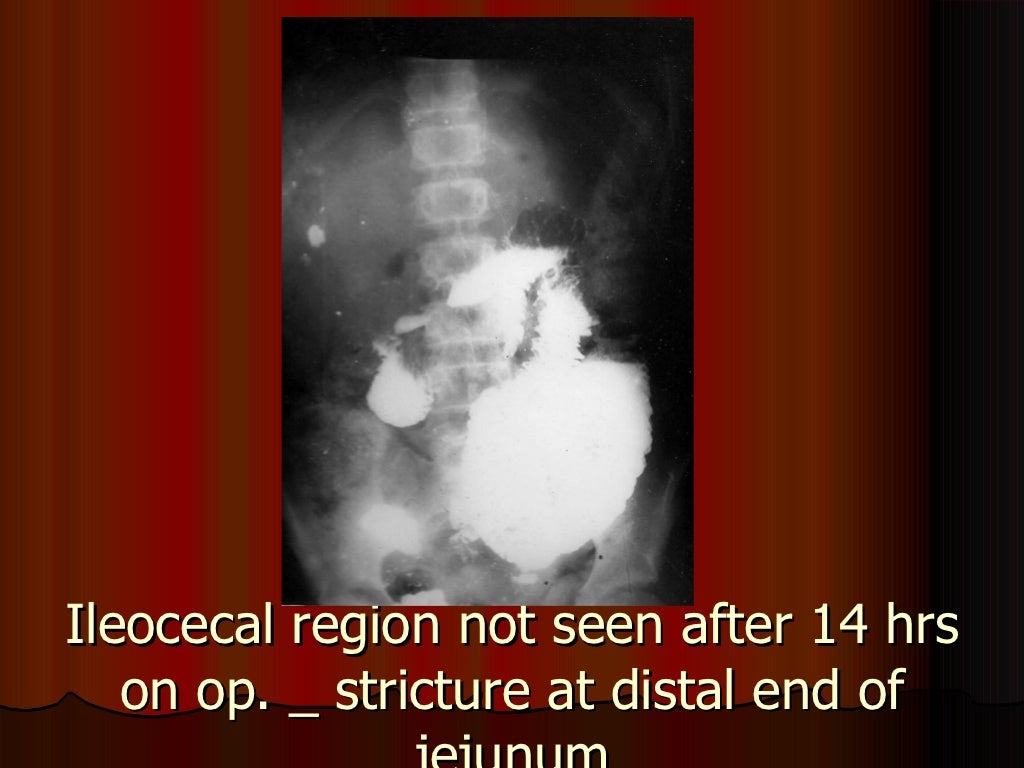 Ba follow through study for ileocecal region