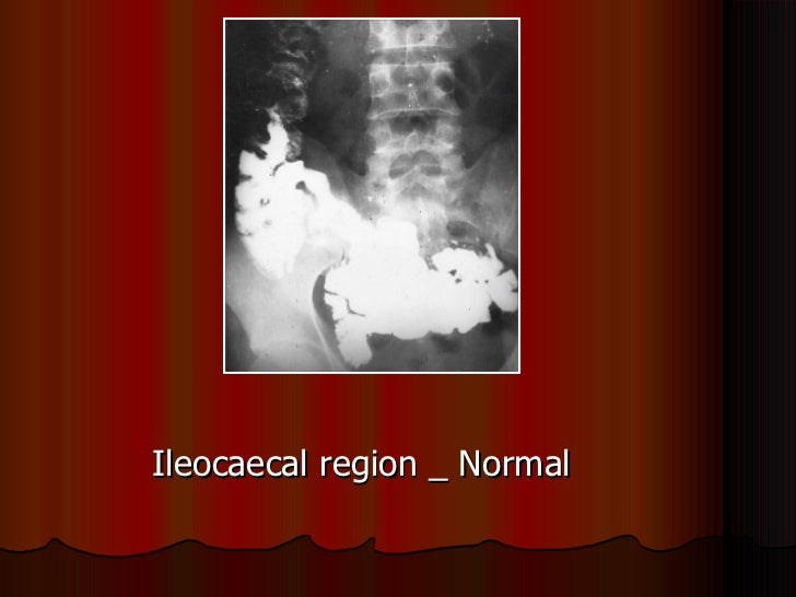 Ba follow through study for ileocecal region