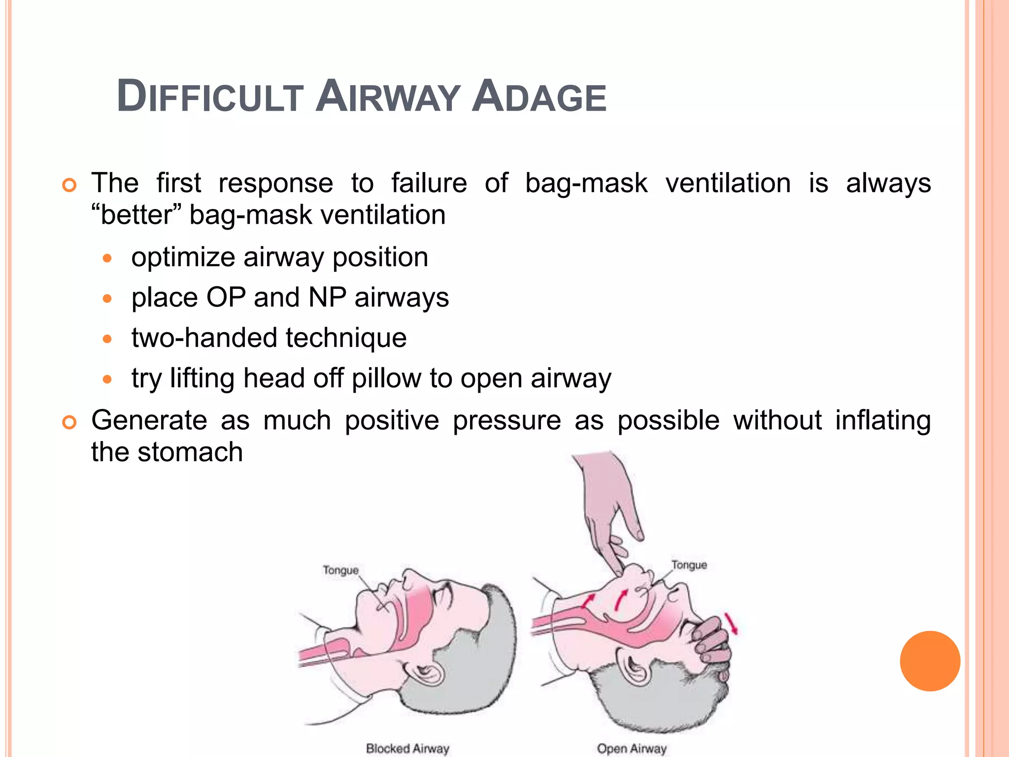 Bag and mask Ventilation | PPTX