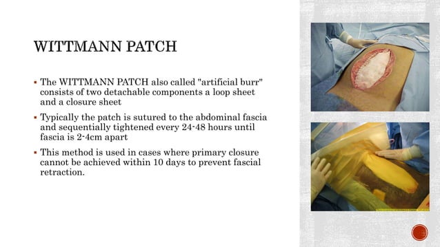 VARIOUS Temporary CLOSURE TECHNIQUES IN OPEN ABDOMEN.pptx