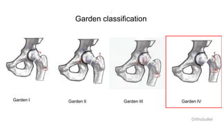 BA gãy cổ xương đùi.pptx