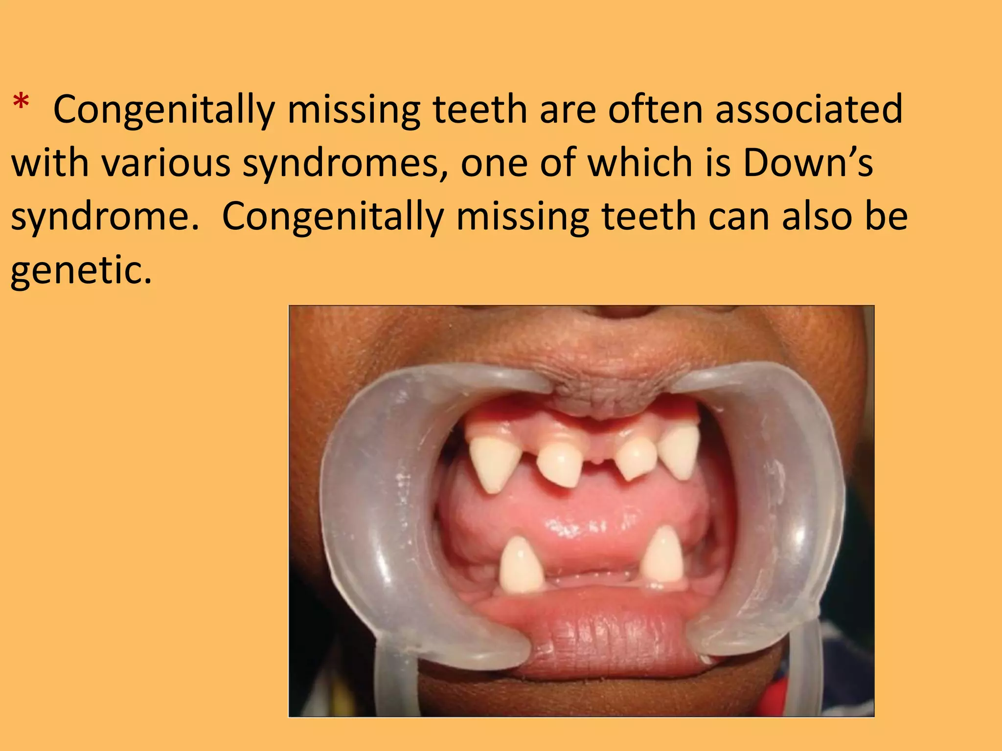 Congenitally missing & supernumerary teeth | PPTX