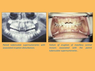 Congenitally missing & supernumerary teeth | PPTX