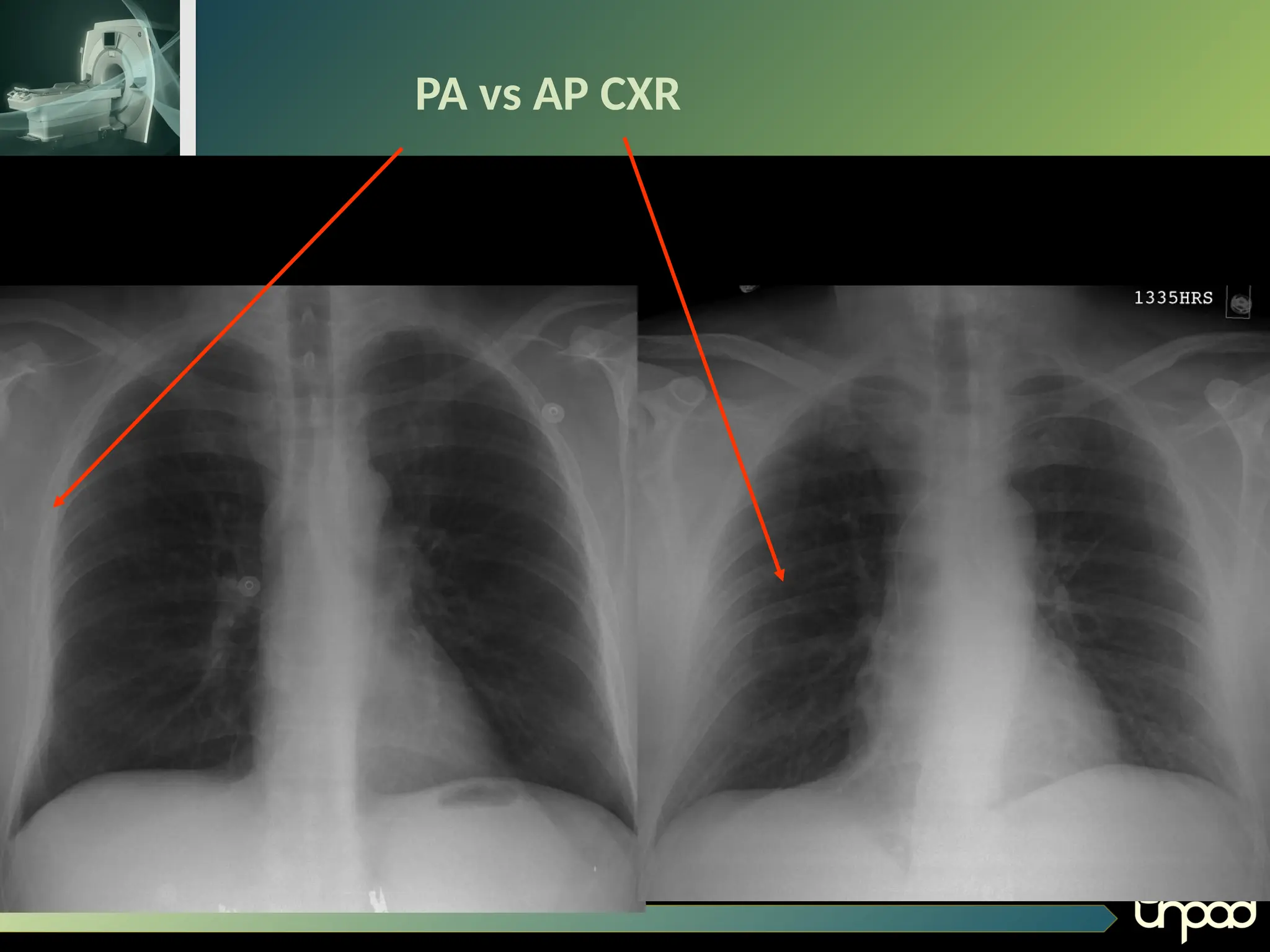 Bahan Thorax Normal untuk radiologi pptx | PPTX