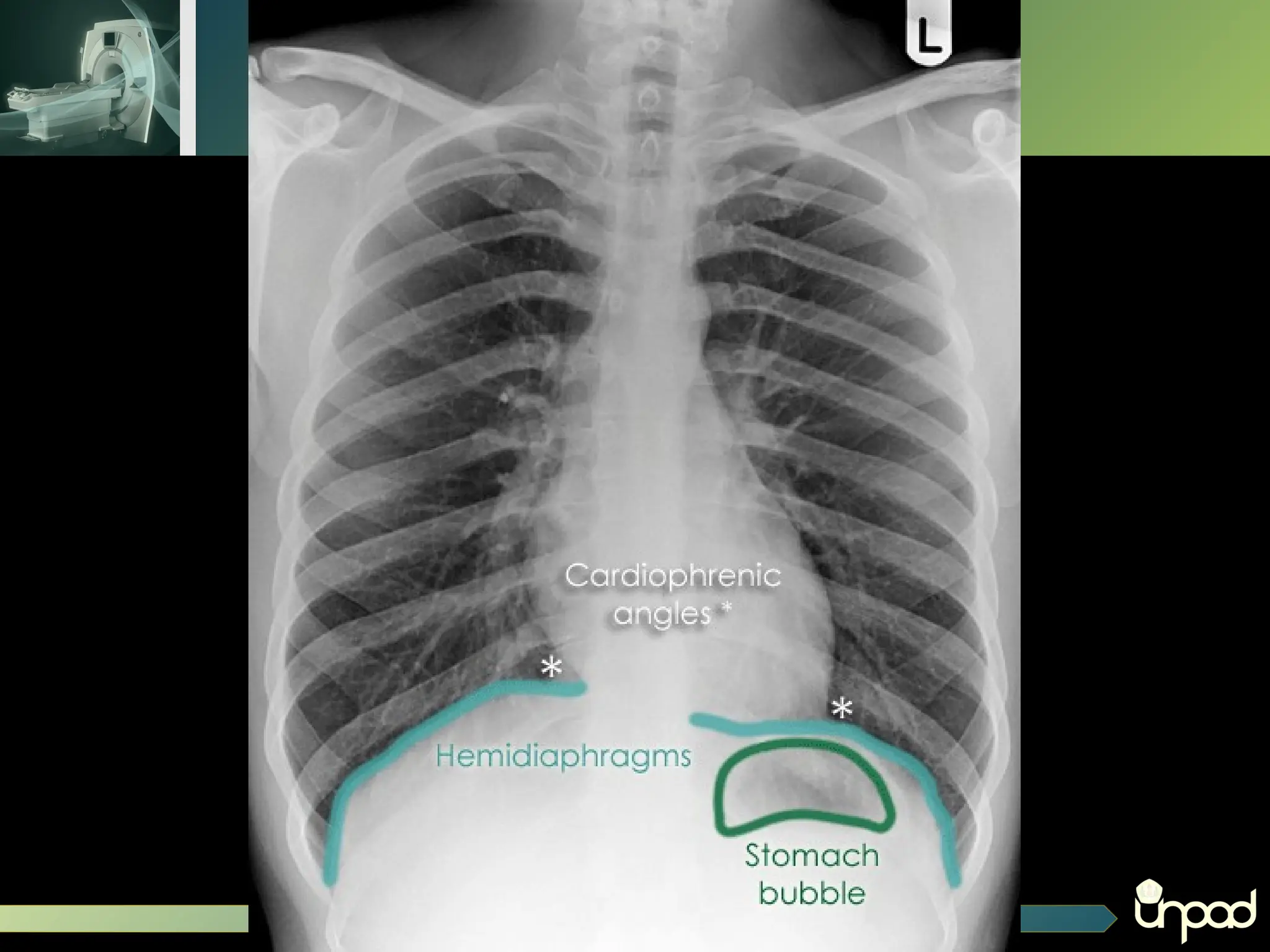Bahan Thorax Normal untuk radiologi pptx | PPTX
