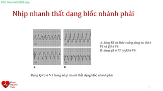 Bai 14-nhip-nhanh-qrs-rong-pham-nguyen-vinh | PPT