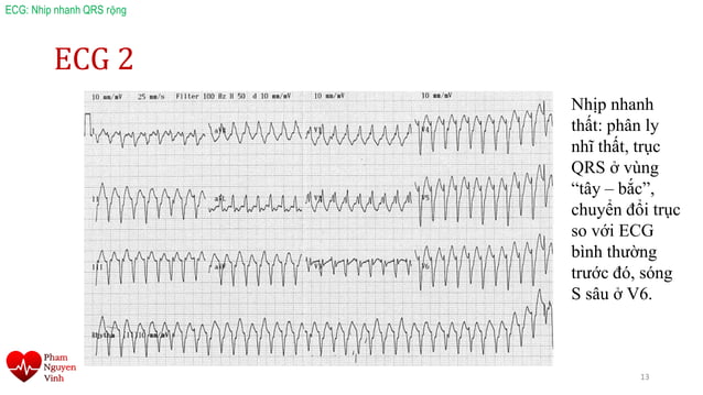 Bai 14-nhip-nhanh-qrs-rong-pham-nguyen-vinh | PPT