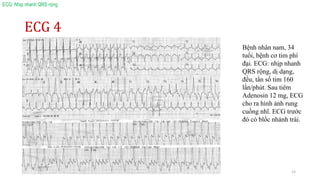 Bai 14-nhip-nhanh-qrs-rong-pham-nguyen-vinh | PPT