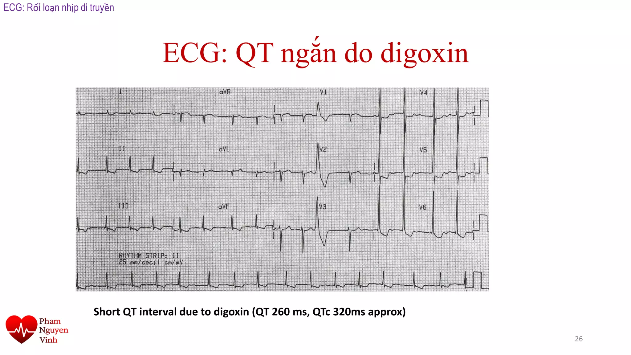 Bai 15-roi-loan-nhip-di-truyen-lop-ecg-pham-nguyen-vinh | PDF