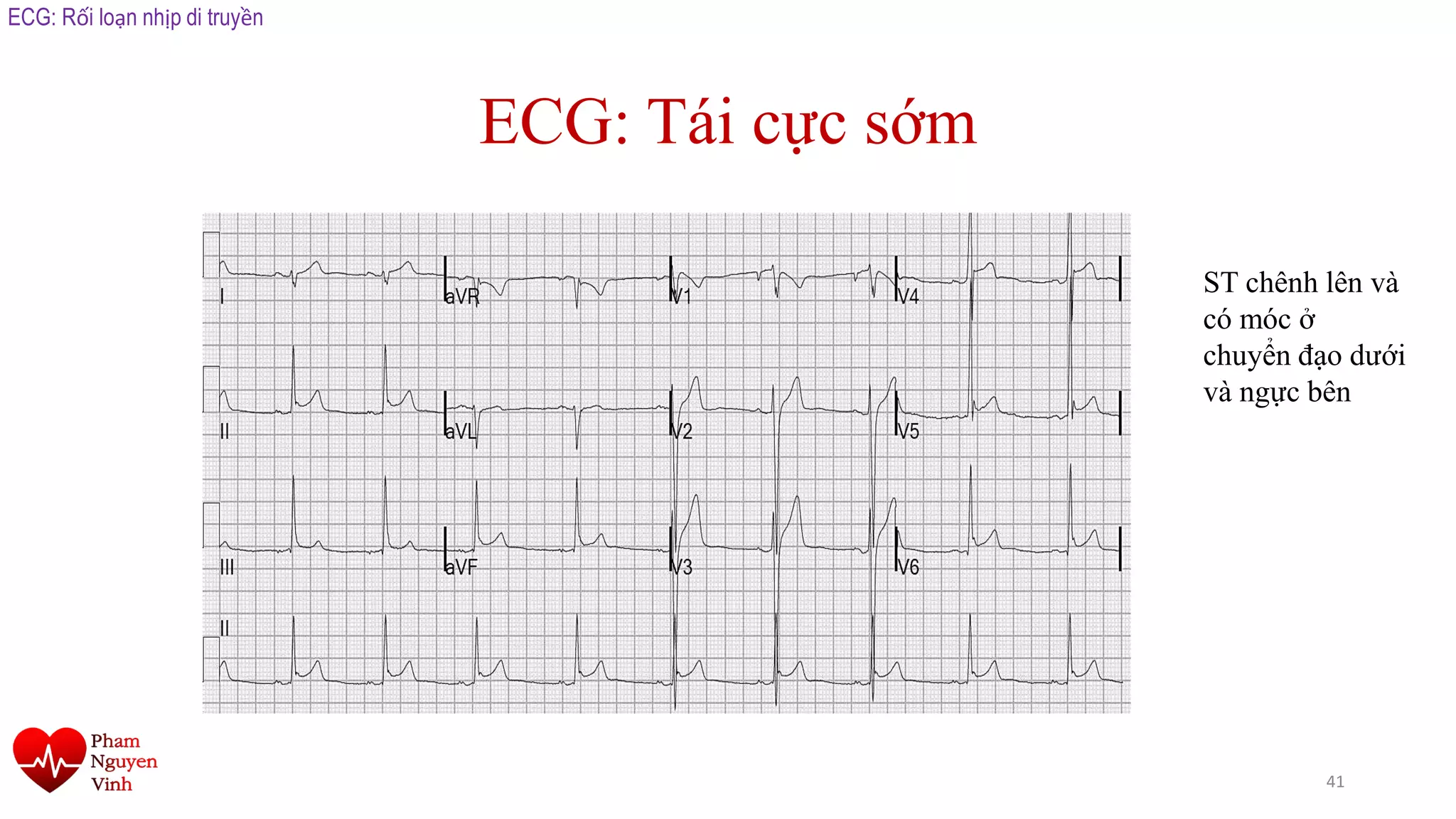 Bai 15-roi-loan-nhip-di-truyen-lop-ecg-pham-nguyen-vinh | PDF