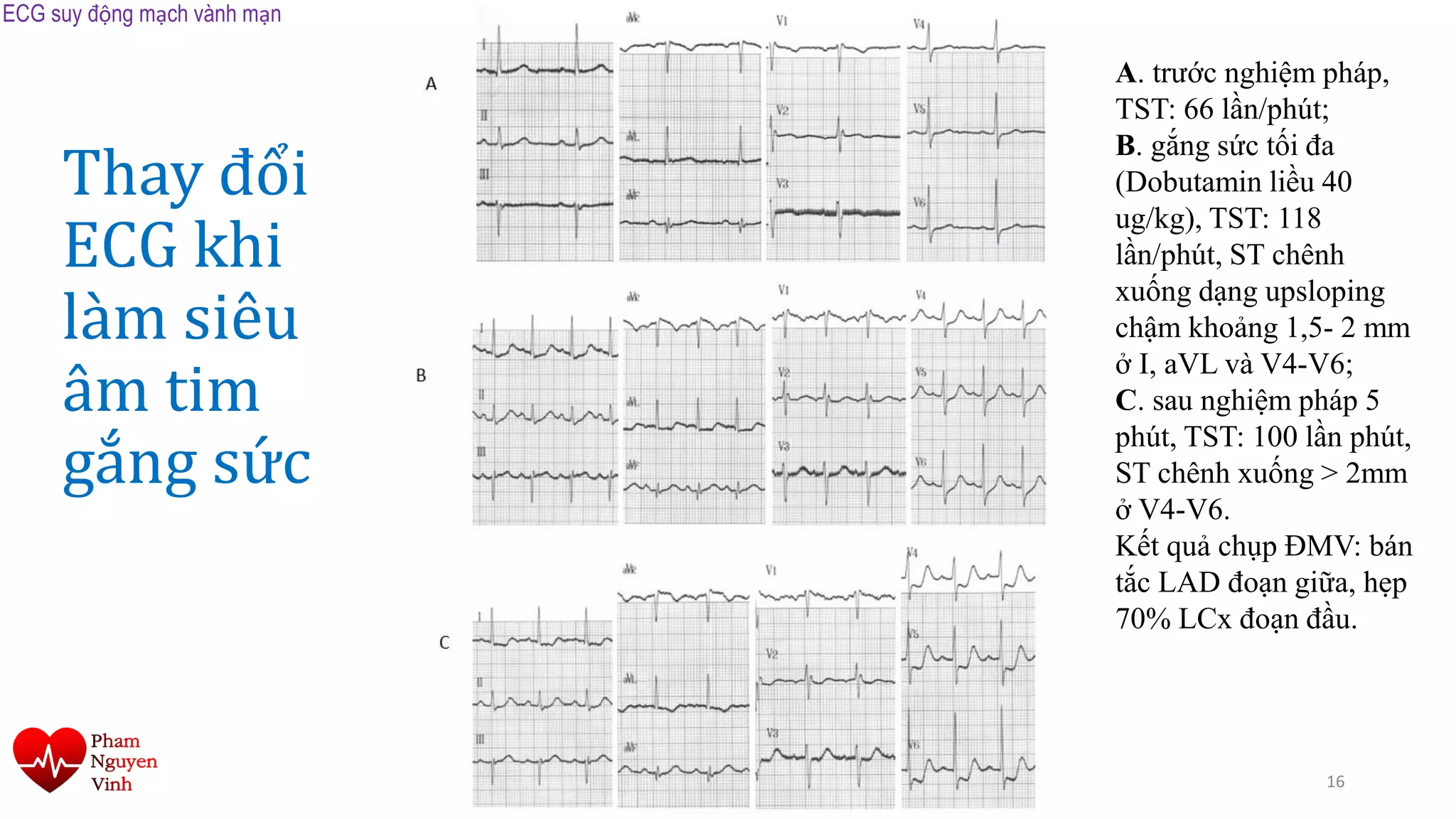 Bai 4-suy-dong-mach-vanh-man-pham-nguyen-vinh | PPT
